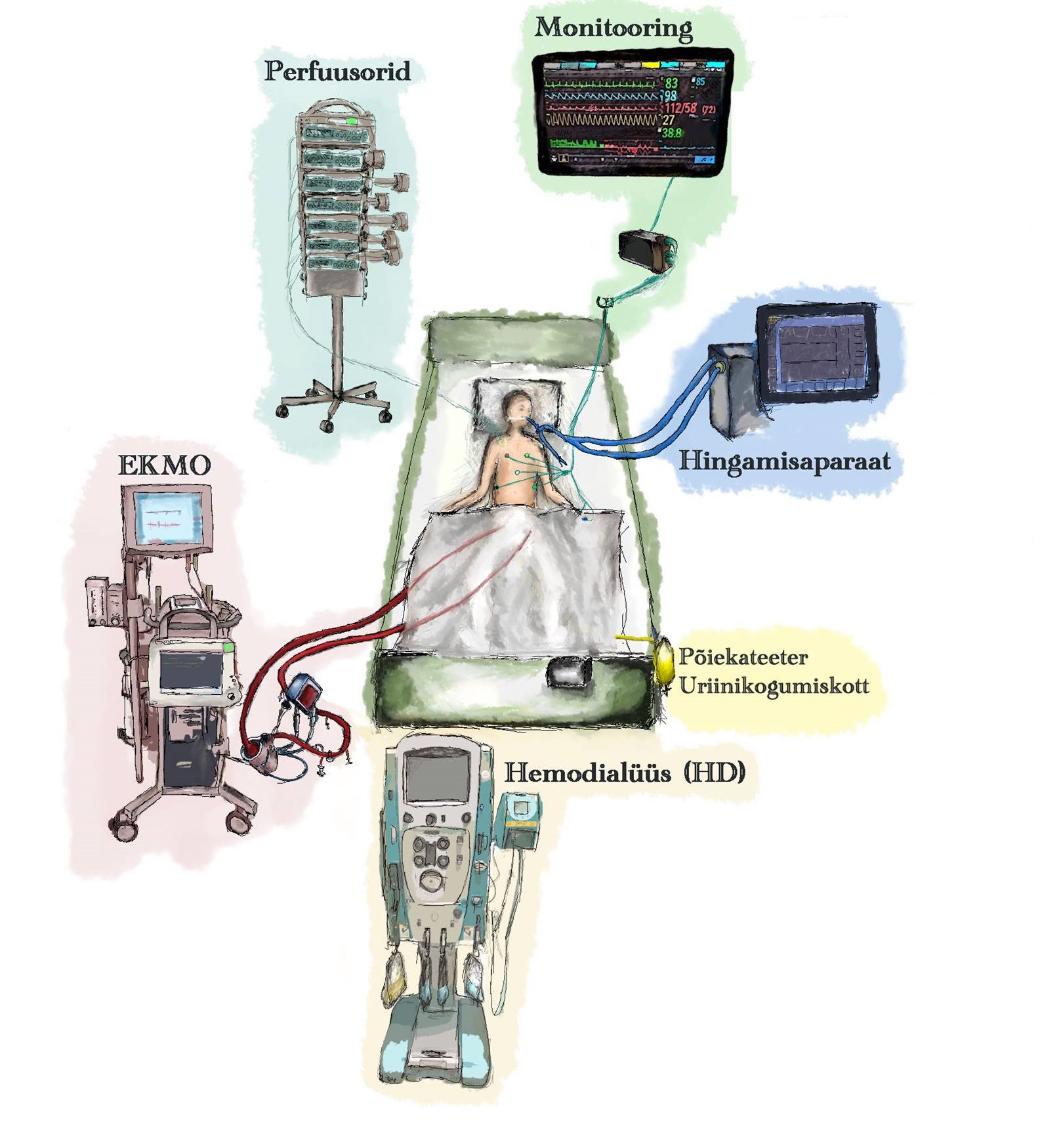 Ekstrakorporaalne membraanoksügenisatsioon (EKMO) - Tartu Ülikooli ...