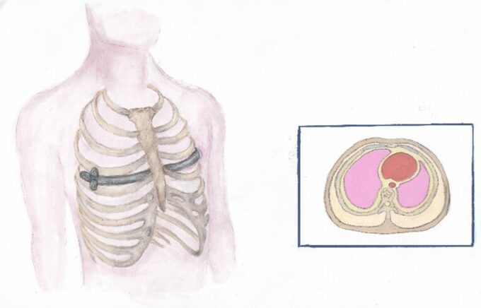 Õõnesrinna operatsioon - Tartu Ülikooli Kliinikum